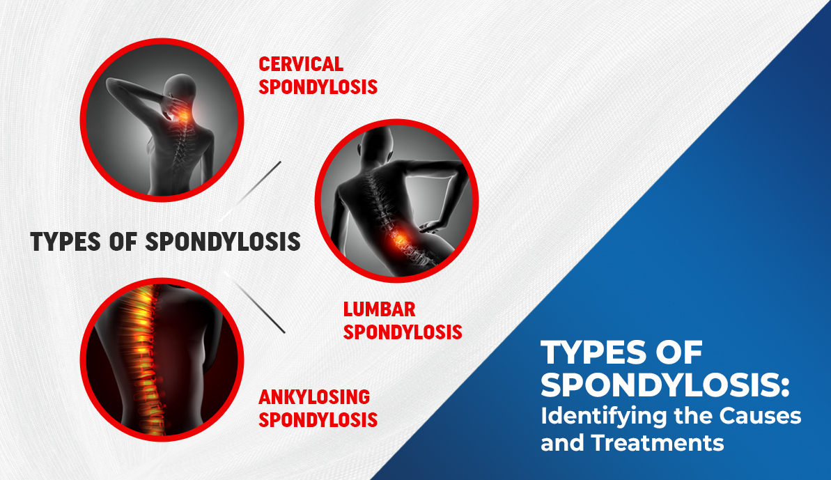 Types of Spondylosis: Identifying the Causes and Treatments